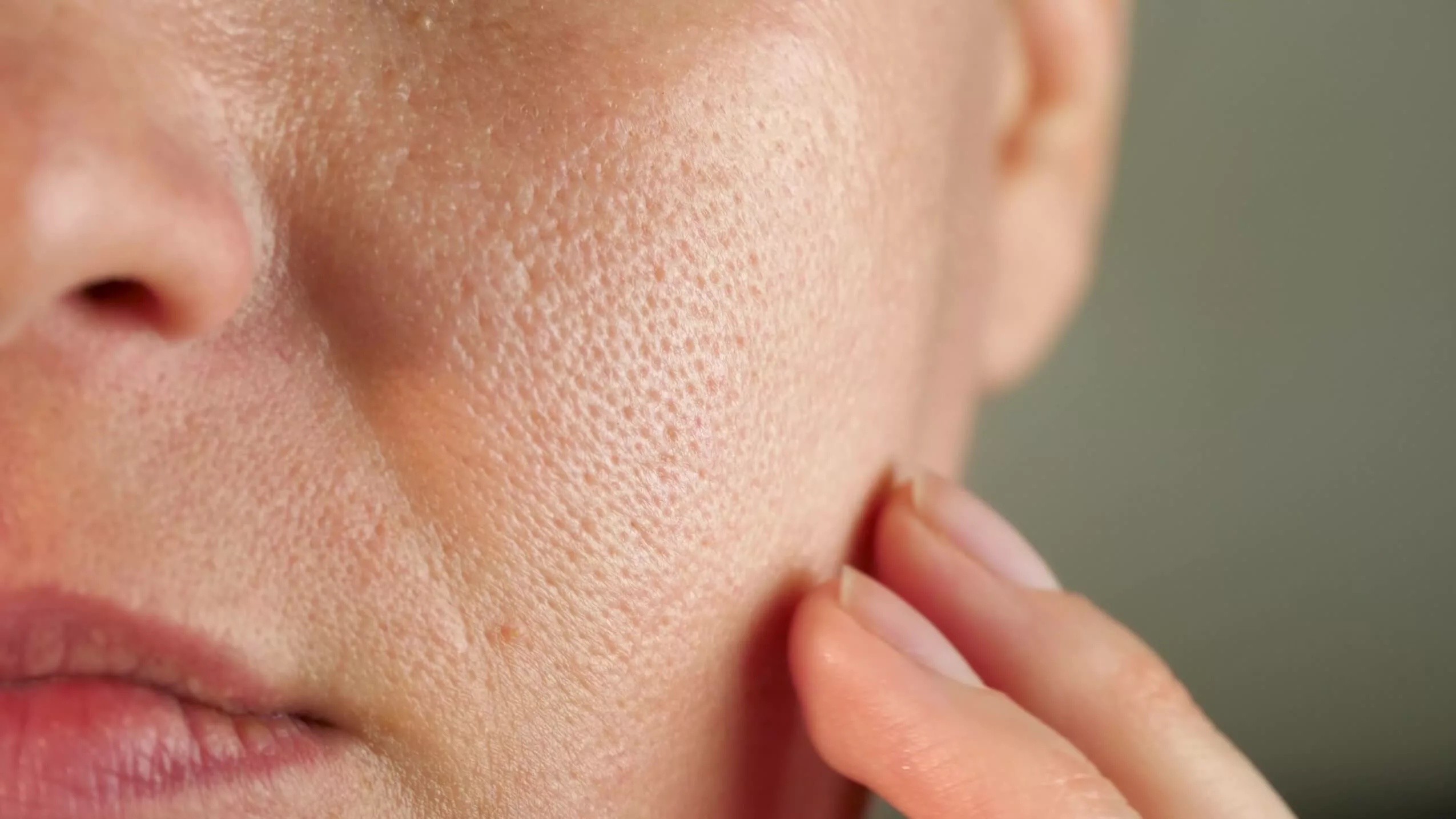 Traitement de la couperose à Paris 15 | Laser vasculaire